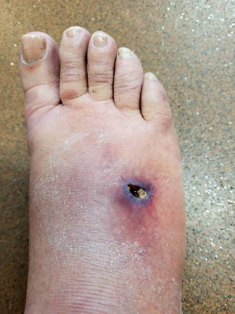 Stingray Stinger Removal