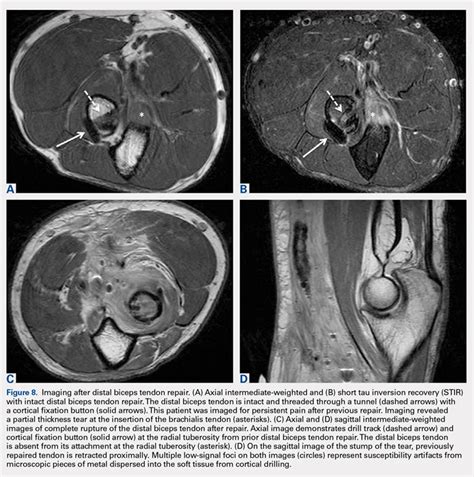Magnetic Resonance Imaging Evaluation Of The Distal Biceps Tendon