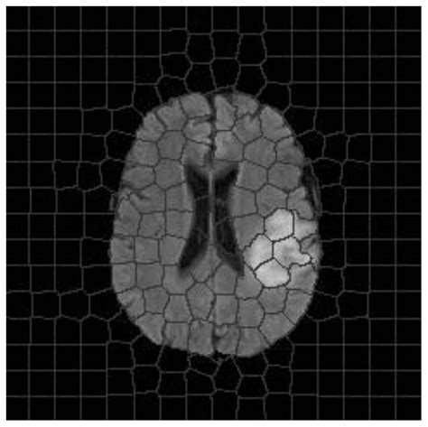 A Method For Automatic Segmentation Of Brain Tumor Images Based On Superpixel Fuzzy Spectral