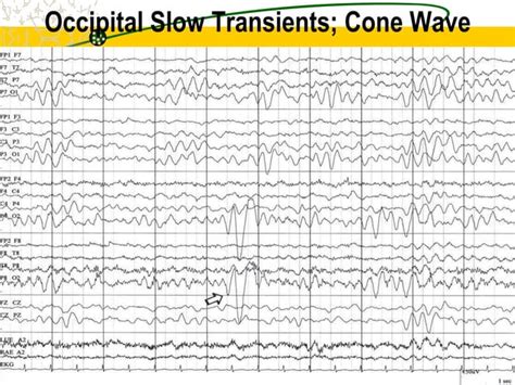 Positive Occipital Sharp Transients Of Sleep Posterior Slow Wave Transients Associated With Eye