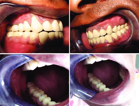 Group Function Type Of Occlusion On Right And Left Sides Download Scientific Diagram