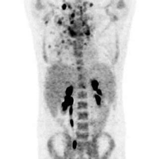 Maximum Intensity Projection PET CT Image Of One Patient With False