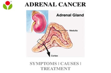 Adrenal Cancer