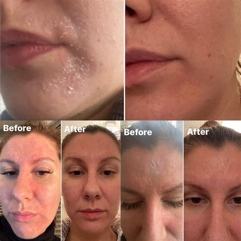 Eczema Skincare Routine And Products To Use To Help Soothe And Ease
