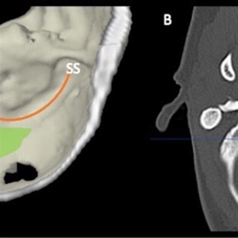 Ab Preoperative Axial Ct Scan With 3d Reconstructions Iplan