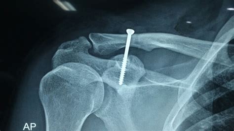 Acromio Clavicular Dislocation Prof Nay Win