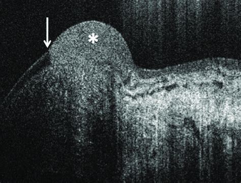 High Resolution Optical Coherence Tomography Oct Of Ocular Surface