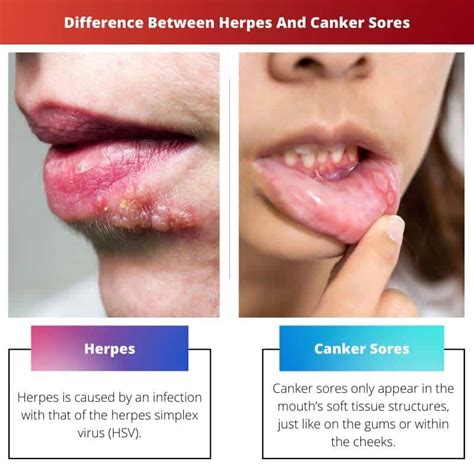 Herpes Vs Canker Sores Difference And Comparison