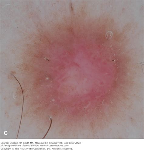 Candida Vulvovaginitis Basicmedical Key