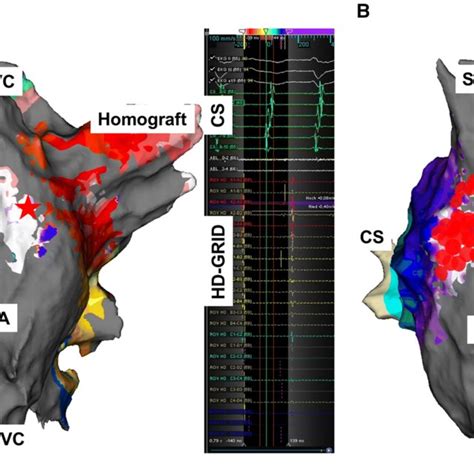Local Activation Time Map Of A Left Atrial Macroreentrant Tachycardia Download Scientific