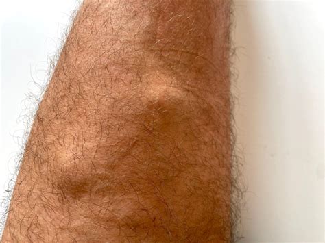 Lipome Bilder Lipome Net