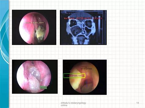 Nasal Polyps Etiology Pathogenesis Clinical Features Management Pptx