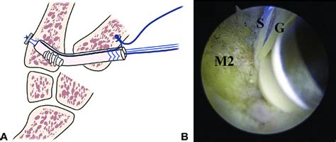 A Schematic Illustration Of The Suspension Graft Secured To The Second