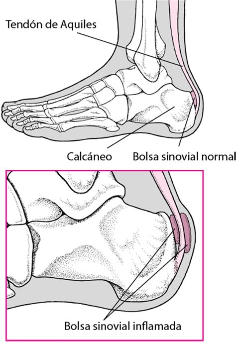 Bursitis Del Tendón De Aquiles Trastornos De Los Huesos
