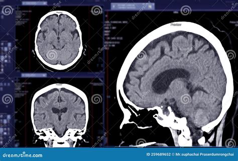 大脑的ct扫描 库存照片 图片 包括有 医生 老年痴呆 紧张 头晕 头盖骨 头疼 癫痫症 259689652