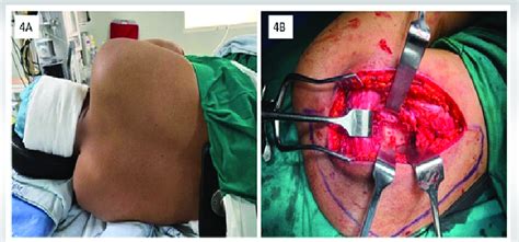 The Patient Was Placed In Lateral Position And The Scapula Was Exposed Download Scientific