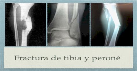 27 Fractura De Tibia Y Peroné [ppt Powerpoint]