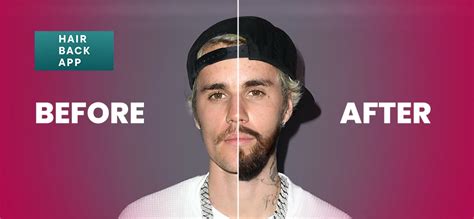 Justin Bieber Hair Transplant Amazing Beard Result 2024