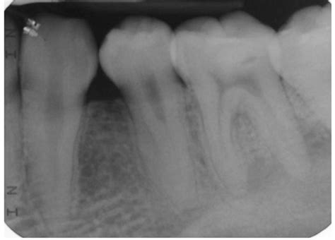 Periapical Radiograph Of Tooth 36 Download Scientific Diagram