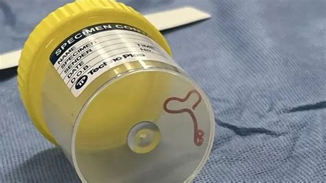 A Live Worm Inside The Womans Brain Doctors Warn