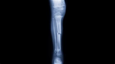 Tibia Shinbone Fracture Types Symptoms Treatment