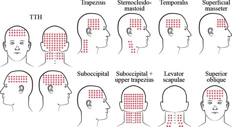 What Common Occurrence Cause The Most Headache
