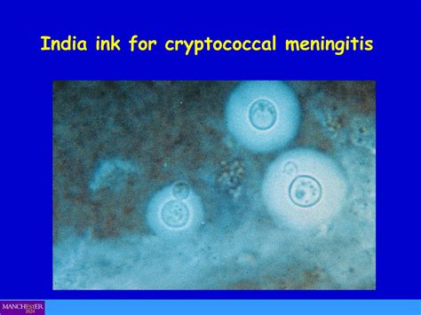 Ppt Cryptococcal Pneumonia And Meningitis Powerpoint Presentation Free Download Id 6725857