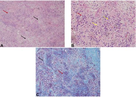 Bronchiolitis Obliterans Organising Pneumonia As An Initial