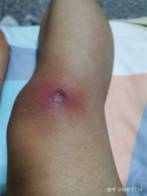 —火疖子—痈 知乎