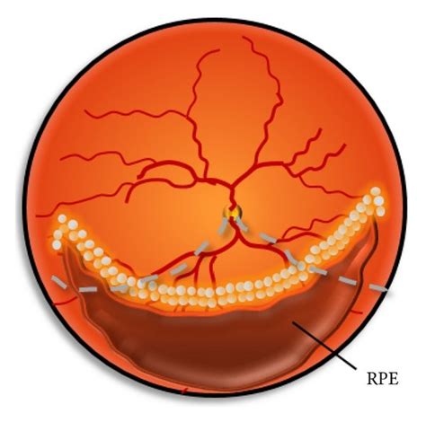 Schematic Drawings Of Traditional Relaxing Retinectomy And Radial