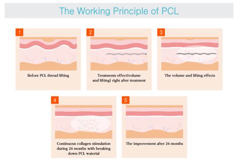 Trends And Evolution Of Thread Lifting PDO Vs PLLA Vs PCL
