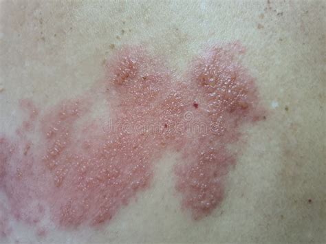 Zona Herpes Zoster São Causadas Por Vírus Vírus Varicellazoster Imagem