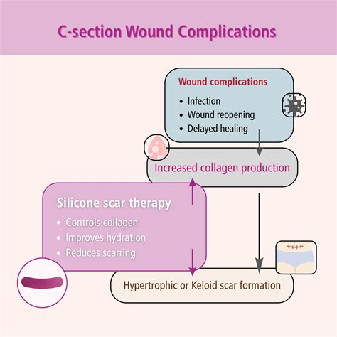 Types Of C Section Stitches And How They Affect Your Scar Recovery