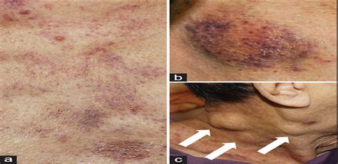 Blastic Plasmacytoid Dendritic Cell Neoplasm Developed On A