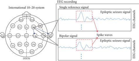 Common Eeg Recording Method Used For Epileptic Seizure Detection