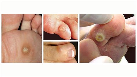 The Podiatry Corns