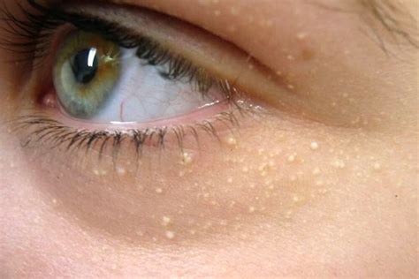 What Are These Tiny White Bumps On My Face Printable Templates Protal