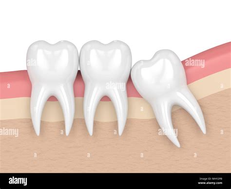 3d Render Of Teeth With Wisdom Mesial Impaction Concept Of Different Types Of Wisdom Teeth