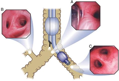 Separation Of The Lung Double Lumen Endotracheal Tubes And Endobronchial Blockers Clinical Tree