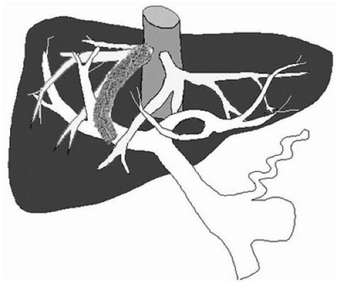 Transjugular Intrahepatic Portosystemic Shunts Radiology Key