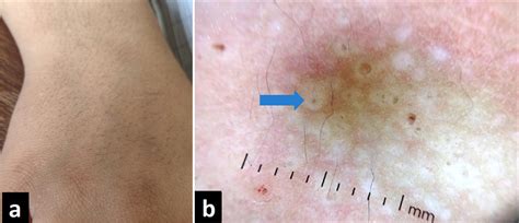 Dermoscopy In Eczema A Magnified Approach To Diagnosis And Management