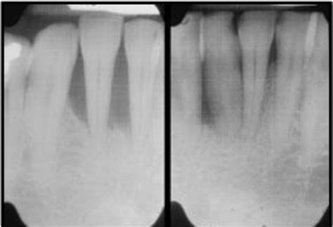 Week 11 Occlusal Techniques And Assessment Forms Flashcards Quizlet