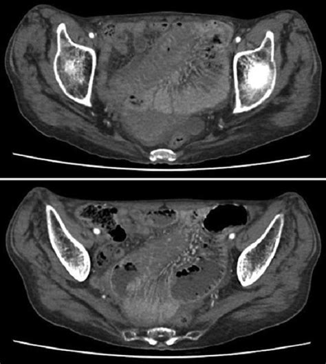 Computed Tomography Disclosed Disproportional Dilatation Of The