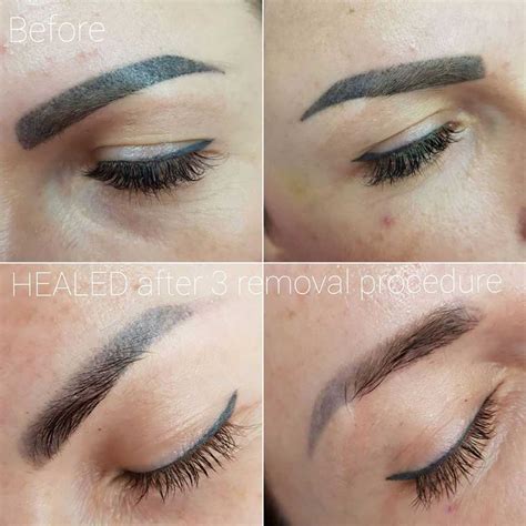 Pmu And Microblading Removal Before And After Gallery