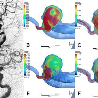 Flow Conditions Before And After Pipeline Embolization Device Download Scientific Diagram