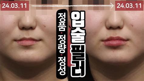 얇고 작은 입술 예쁜 입술로 입술필러 시술 영상 톡스앤필 분당점 야탑 피부과 필러 Youtube