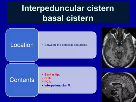 Csf Cisterns Ppt