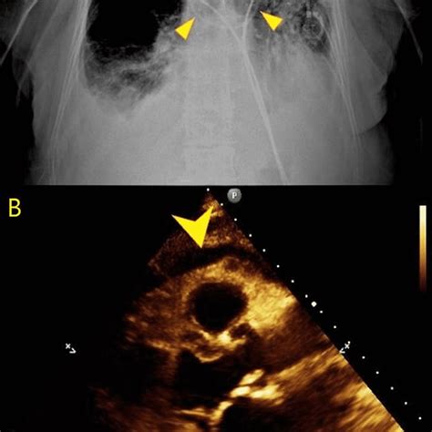 A Chest X Ray Ap View Chest X Ray Demonstrating Bilateral Download Scientific Diagram