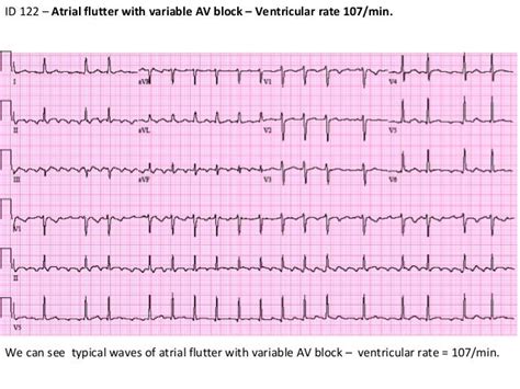 Icd 10 Code For Atrial Flutter Belnery Icd 10 Code For Atrial Flutter Belnery