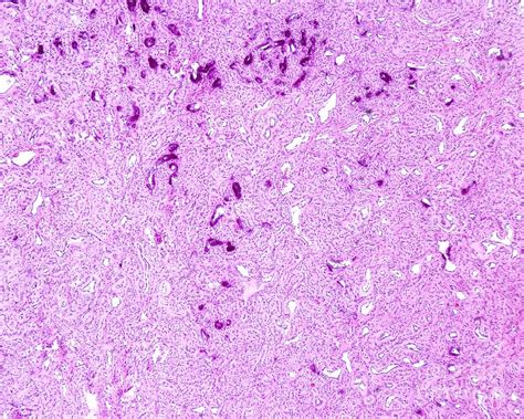 Retiform Hemangioendothelioma Photograph By Jose Calvo Science Photo